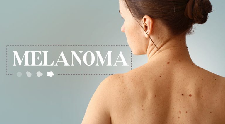 Melanoma (Skin Cancer) Warning Signs - FCP Live-In